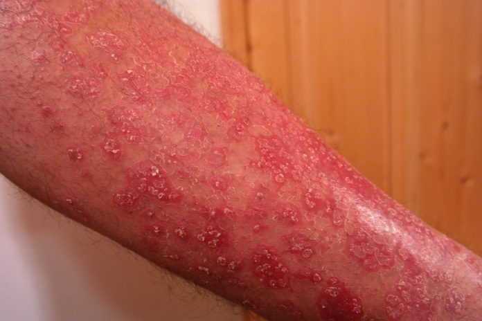Psoriasis Pustulosa: Causas y Tratamiento